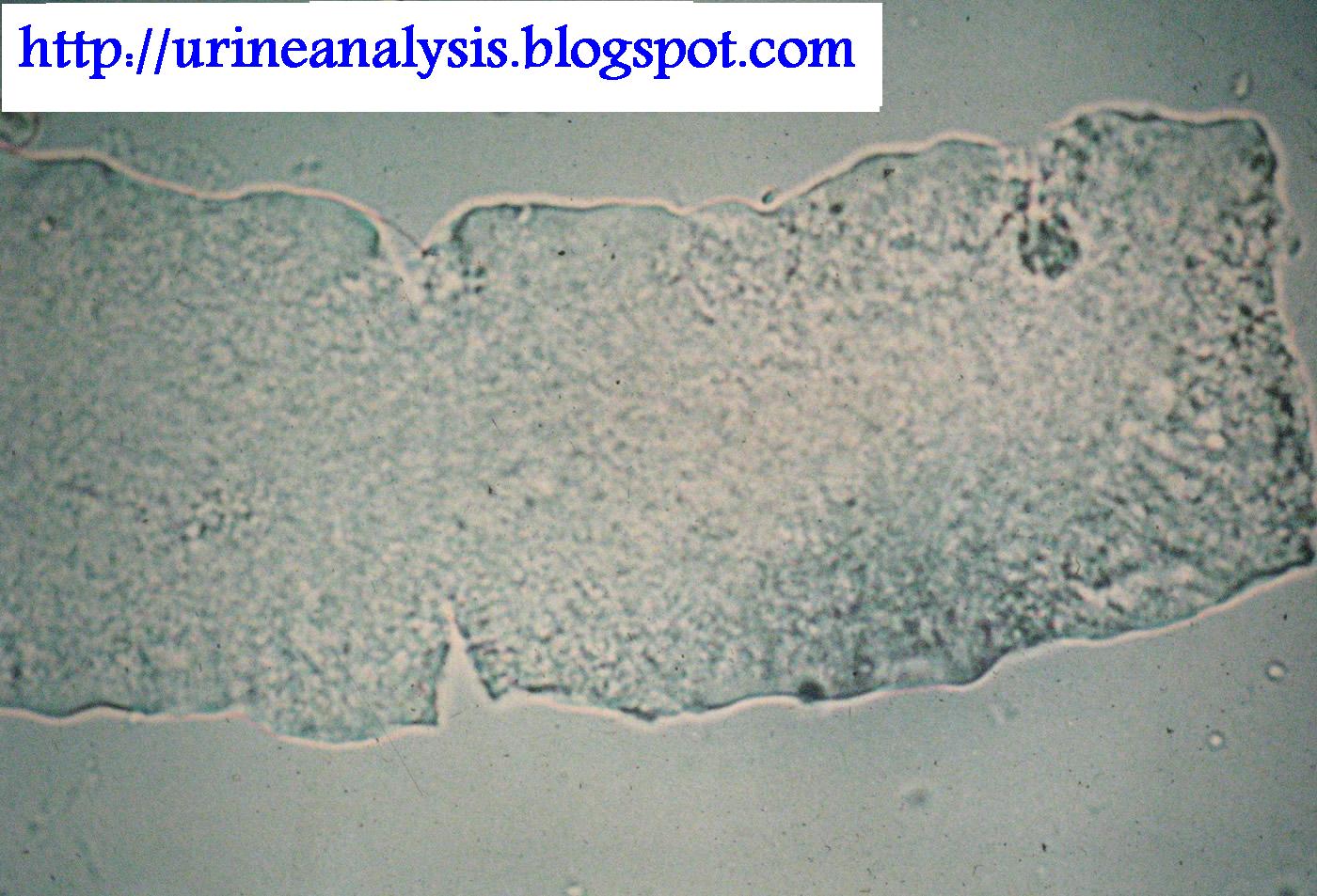 صور مجهرية للإسطوانات شمعية (waxy casts) فى تحليل البول ~ تحليل البول ...