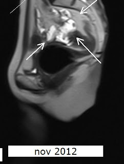 hourglass gallbladder