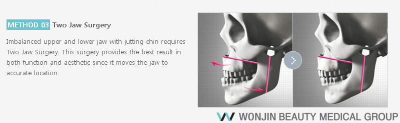 Korea Two Jaw Surgery Wonjin Beauty Medical Group - Jutting Jaw ...