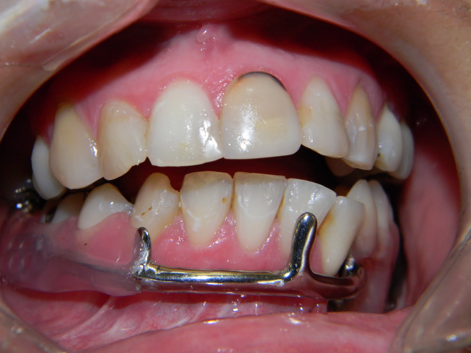 Prótesis Maxilofacial: Que es Prótesis Maxilofacial?