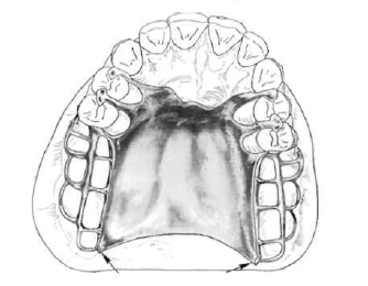 hiphoplife: Tissue Stops in RPD