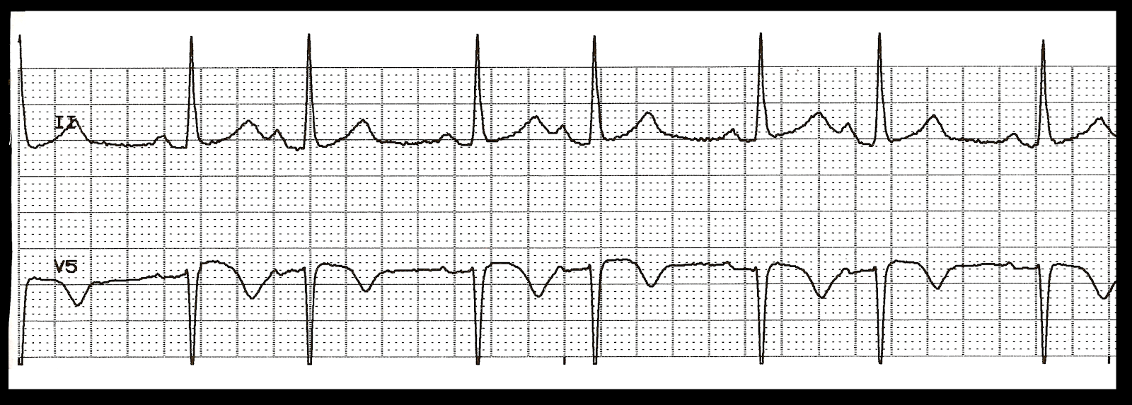 EKG Rhythm Quiz 221