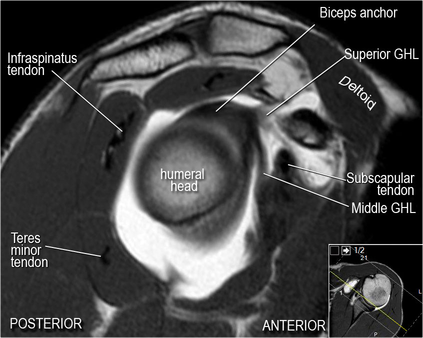 Coracohumeral Ligament Mri