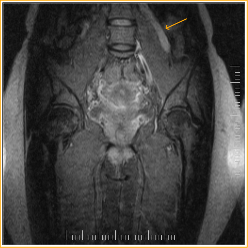 Pelvic Congestion Syndrome Mri Sumers Radiology Blog