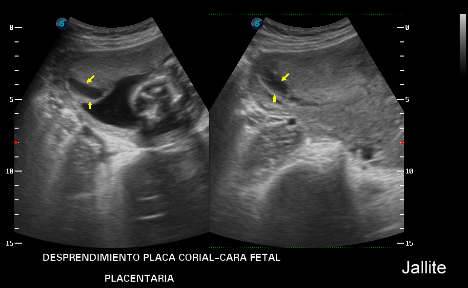 Hematoma Retrocorionico & Placenta Marginal