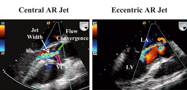ASE Guidelines for the Diagnosis of Aortic Regurgitation