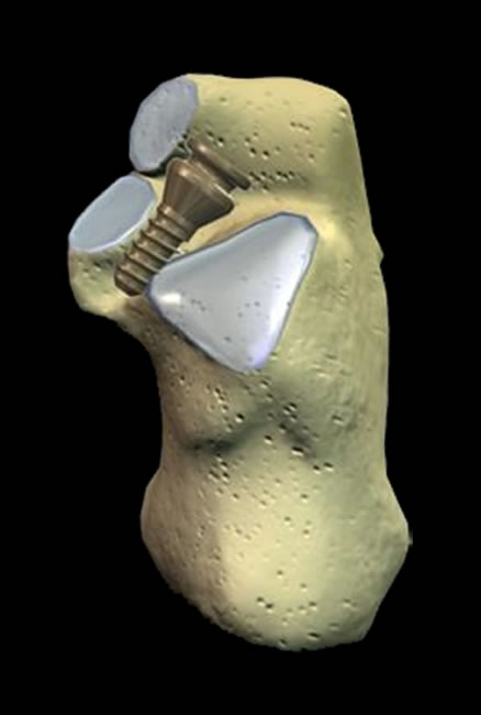 GraMedica®: The HyProCure® Advantage