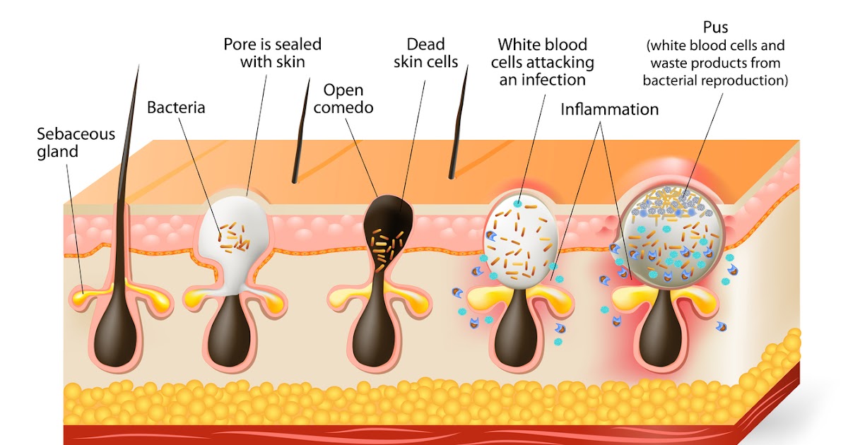 Acne Bacteria and The Acne Environment ~ acne no more