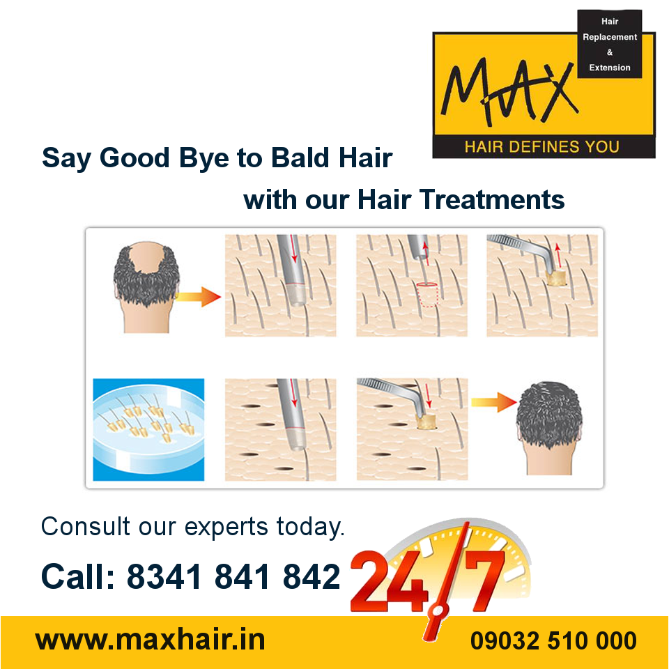 Max Hair Hair Loss Treatment Hyderabad