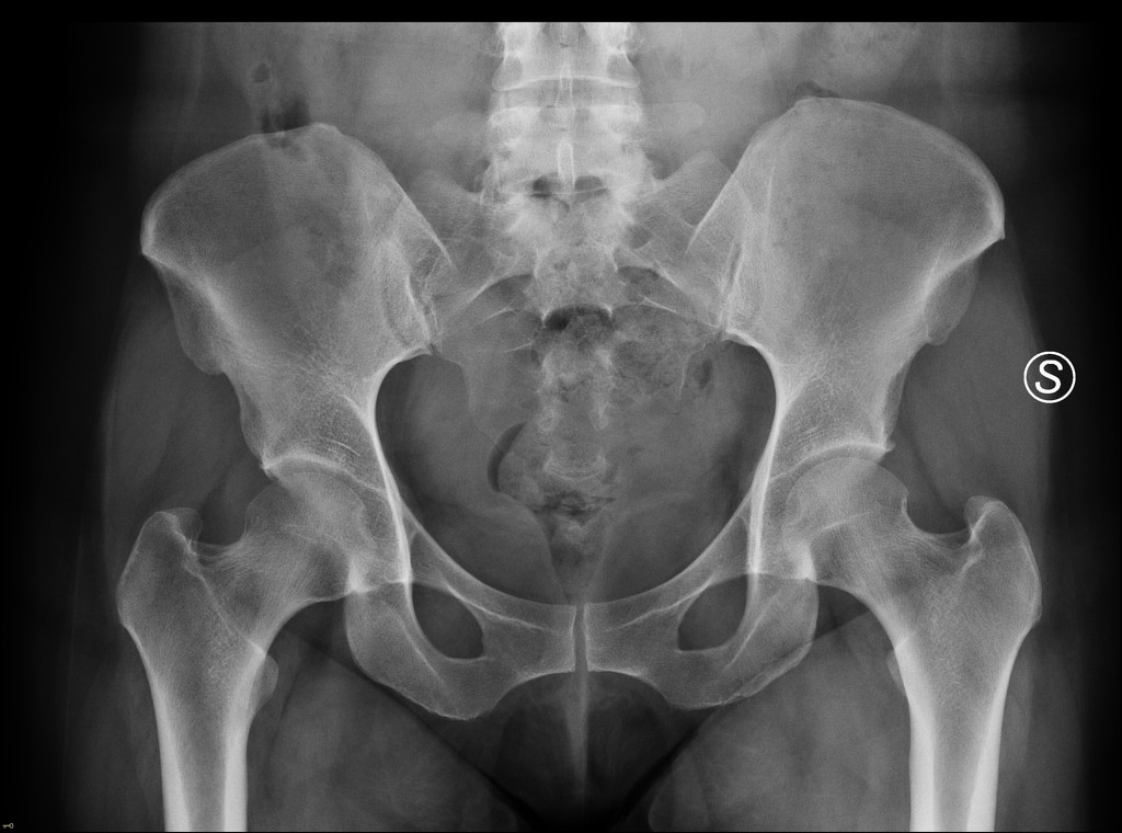 Osteitis Pubis Treatment