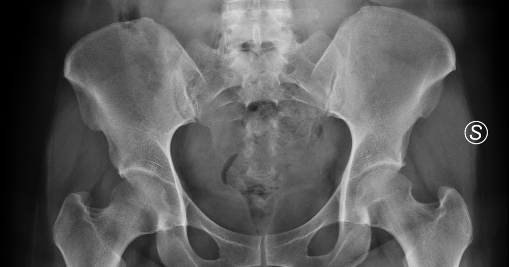 Osteitis Pubis Treatment