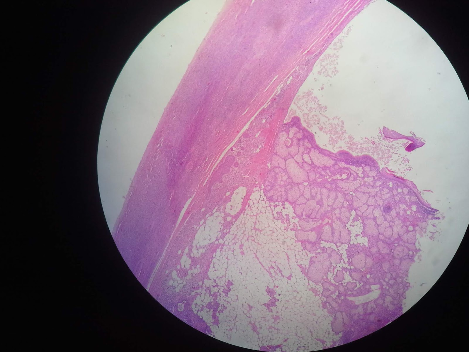 Interesting facts about teratomas and struma ovarii