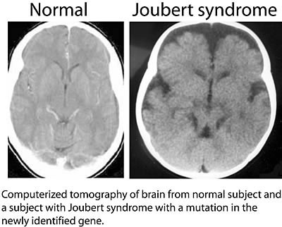 Actualités Scientifiques - Médicales: Syndrome de Joubert: ataxie ...