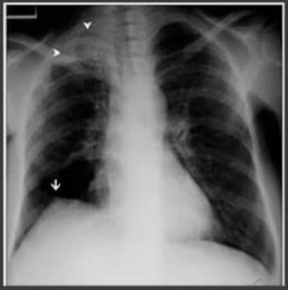 Chest Medicine Made Easy-Dr Deepu: Radiology Signs -Juxta Phrenic Peak Sign