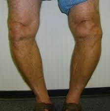 Bowlegs (Genu Varum) - 10-must-know facts ~ PublicWellness Group