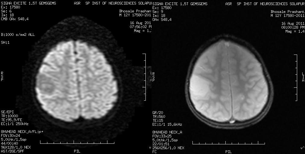 Dr Balaji Anvekar FRCR: Dysembryoplastic Neuro Epithelial Tumor (DNET)