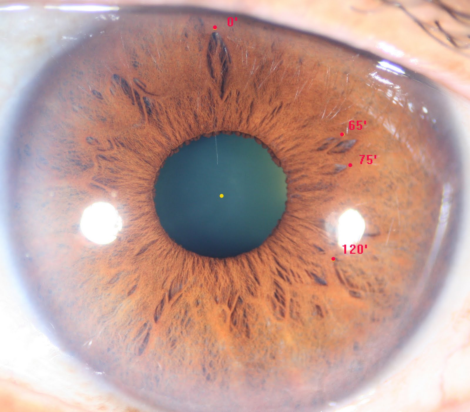 Modern & Multidimensional Iridology: Partial Atrophy IPB, Leaf Lacuna ...