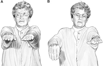 MY Health Venture: Tanda-tanda Serangan Stroke Yang Wajib Setiap Orang Tahu