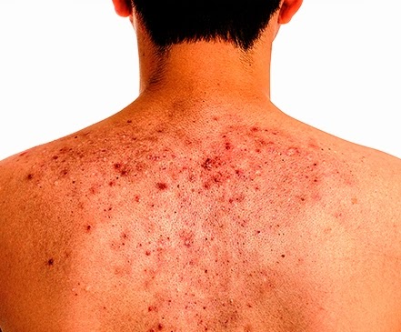 Treating Back Pimples - Remedy for Pimples and Acne