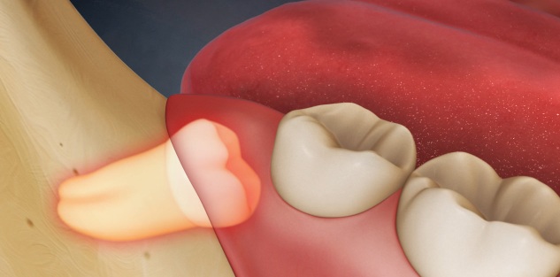 Dr Seah Root Canal & Implant Surgical Clinic: Wisdom Teeth Surgery and ...