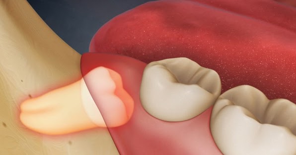 Dr Seah Root Canal & Implant Surgical Clinic: Wisdom Teeth Surgery and ...