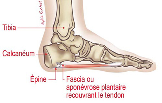 Epine calcanéenne | Jean J. Weaver