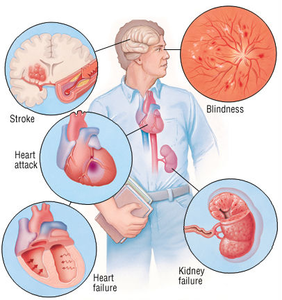 Health And Nutrition Care Tips: Understanding Hypertension or High ...