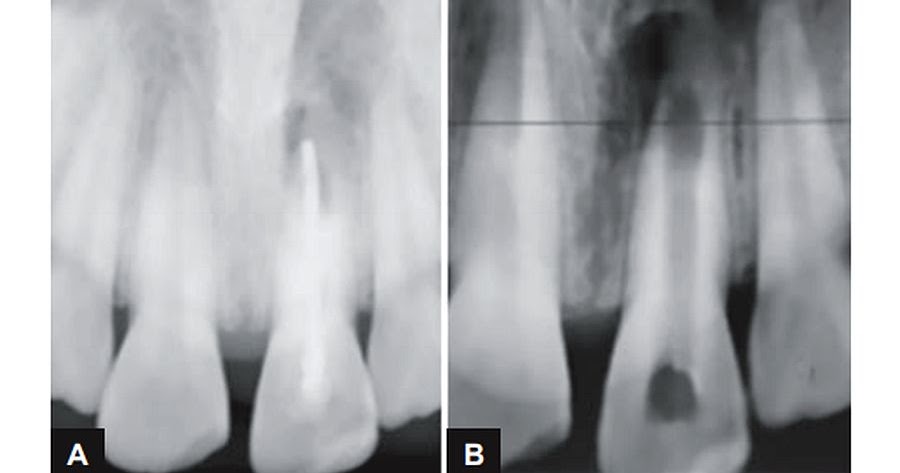 PDF: Management of Internal Resorption with Perforation - Ovi Dental