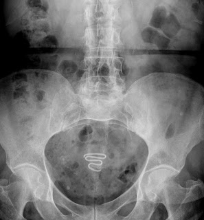 O Radiologista: DIU Atípico