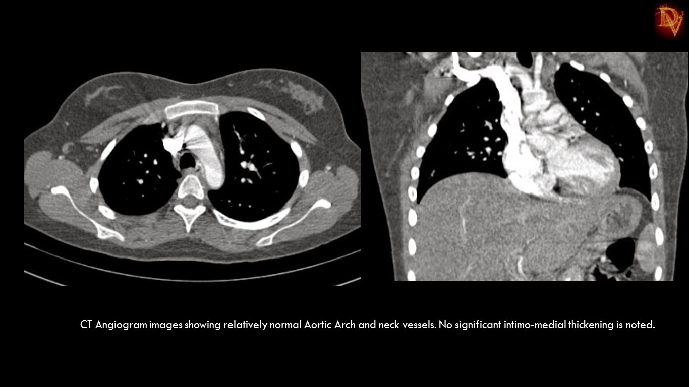 Ultimate Radiology : TAKAYASU ARTERITIS : A less common presentation