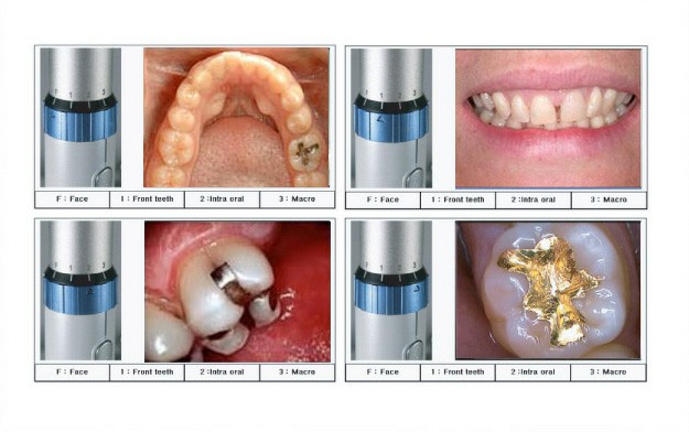 Crystal Lake Dental's Hot topics: Improved Cavity Detection Crystal ...