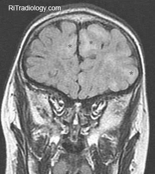 RiT radiology: Tuberous Sclerosis Complex