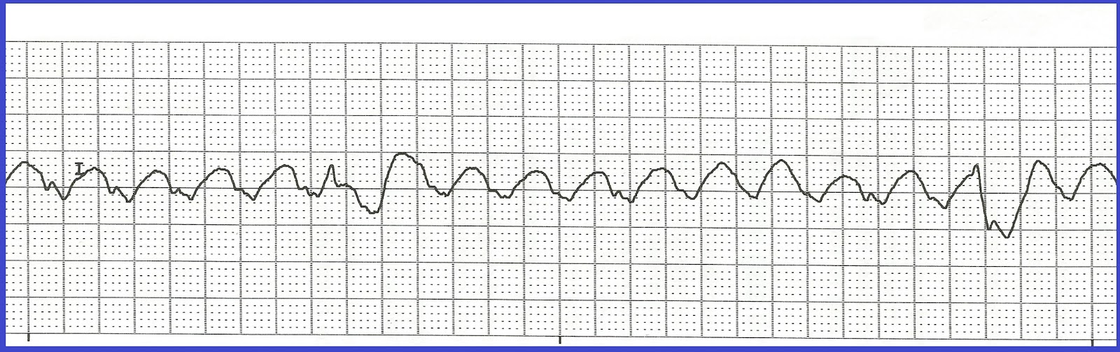 Code Blue: Cardiac arrest
