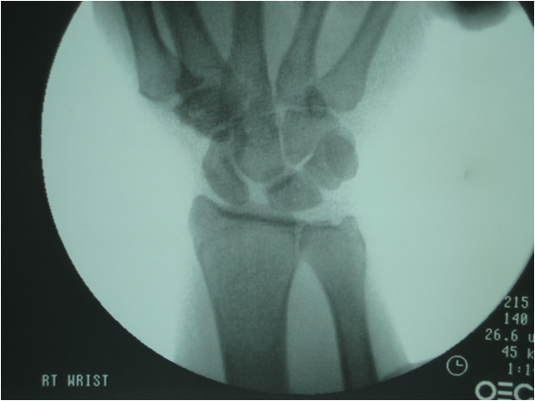 Orthopedic Surgery at Maimonides Medical Center: Fluoroscopy better ...