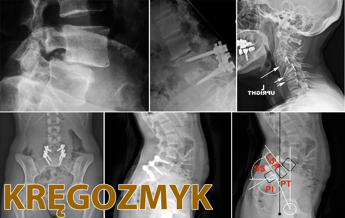 Kręgozmyk i retrozmyk – utrata stabilności kręgosłupa | Leczenie kręgosłupa