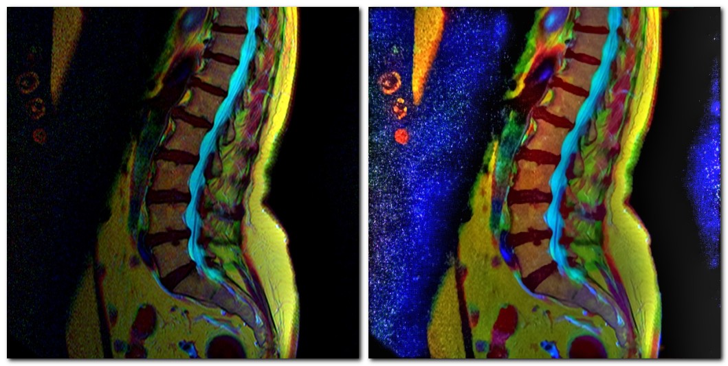 Nevit's blog: Color MRI of the Lumbar spine tonemapped.