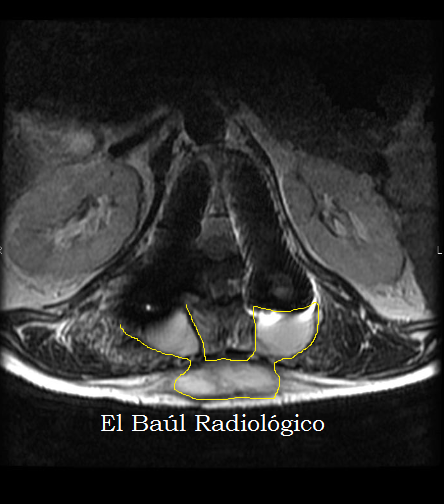 El Baúl Radiológico: SEROMAS POSTQUIRÚRGICOS PARAVERTEBRALES (Lumbar ...