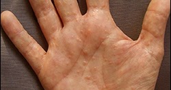 Herbal Remedies for Pompholyx - Symptoms, Causes, Diagnosis & Treatment ...