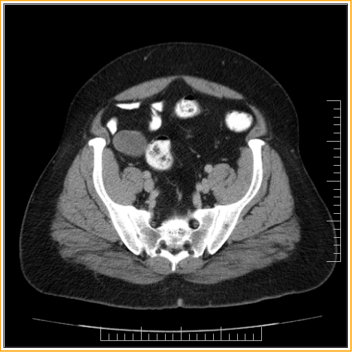 Appendiceal Mucocele: CT - Sumer's Radiology Blog