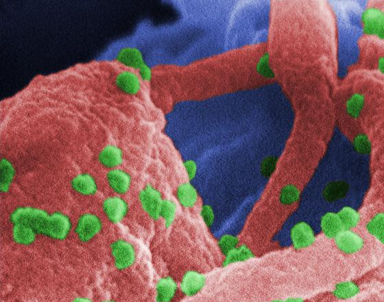 EL VIH: EL VIH - SIDA - CAUSAS Y TRATAMIENTO