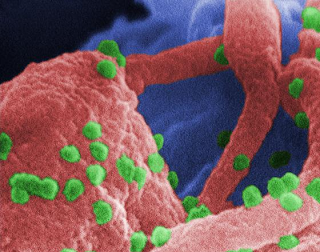 EL VIH: EL VIH - SIDA - CAUSAS Y TRATAMIENTO