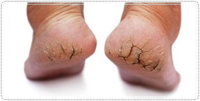 Clinica dermatológica Natividade & Cohen: Ressecamento dos pés.