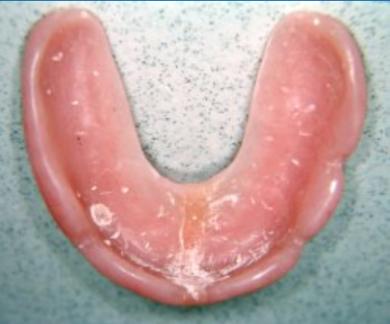 Dentistry lectures for MFDS/MJDF/NBDE/ORE: DENTURE FRACTURE & REPAIR ...