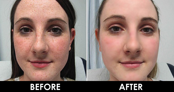 How To Get Rid Of Face Freckles At Home - Style Hunt World