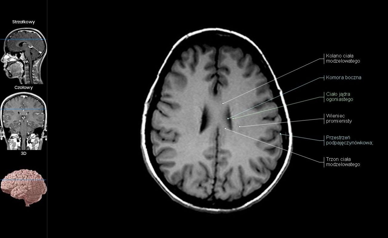 RM głowy - anatomia mózgowia (MRI) T1-axial