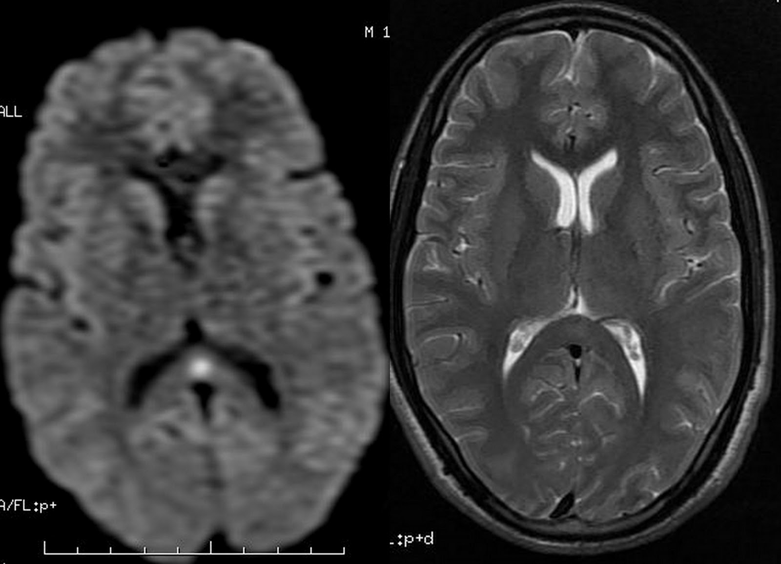 Dr Balaji Anvekar FRCR: Role of MRI Diffusion