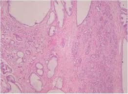 Dr.EDUARDO BERCOVICH: Diabetes tipo 1: Infecciones Urinarias