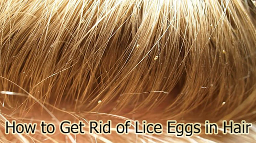 How to Get Rid of Lice Eggs in Hair
