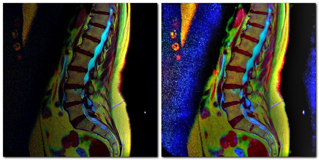 Nevit's blog: Color MRI of the Lumbar spine tonemapped.