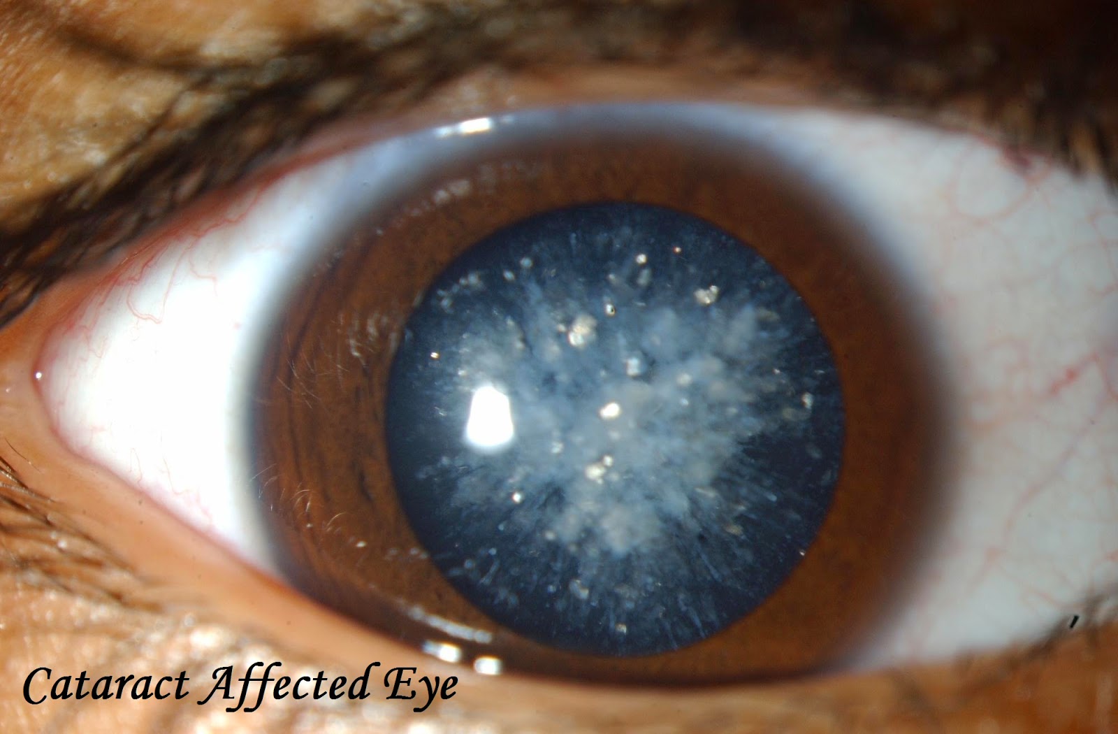 Treatment of Cataract by Ayurveda in Jaipur, India